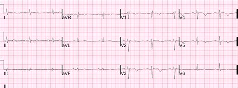 Dr Smiths Ecg Blog Pseudonormalization Of Wellens Waves
