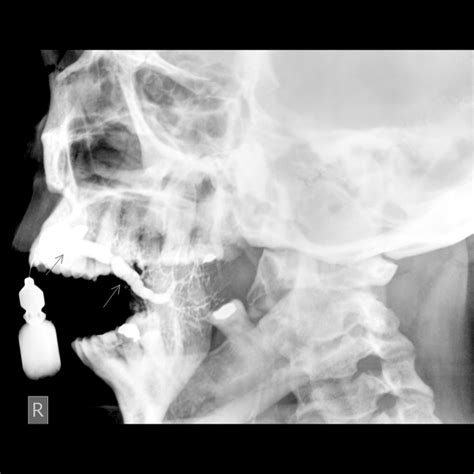 Submandibular Fossa Radiograph