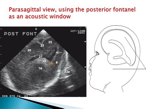 Ppt Neonatal Cranial Ultrasound Part 1 Technical Aspect And Normal