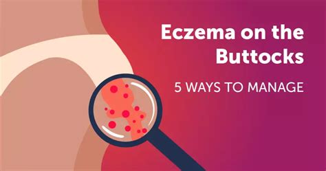 5 Ways To Manage Eczema On The Buttocks Myeczemateam