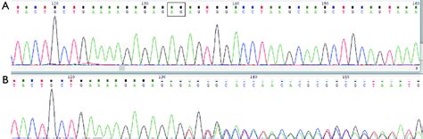 Electropherogram Of Sanger Analysis Showing A Normal Sequence And