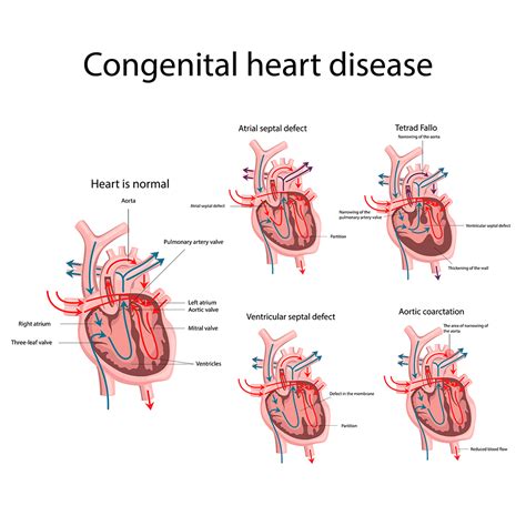 Basics Of Congenital Heart Disease Dr Raghu