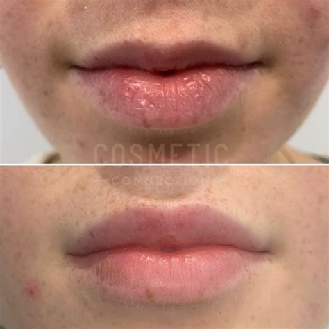 Understanding 1ml Lip Filler Impact Cosmetic Connection