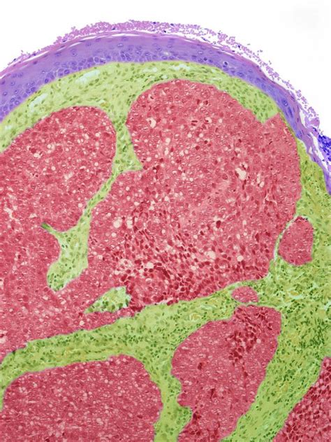 Skin Cancer Photograph By Steve Gschmeissner Pixels
