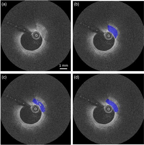 Crf Refinement Of Segmentation Improves Segmentation Performance A