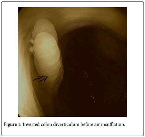 Case Study Inverted Diverticulum Colonoscopy Evaluation Prior T