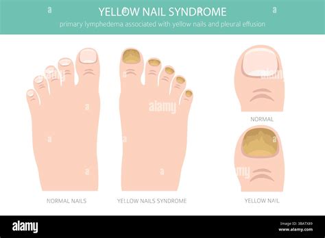 Yellow Nail Syndrome Is A Rare Condition Marked By Thick Slow Growing