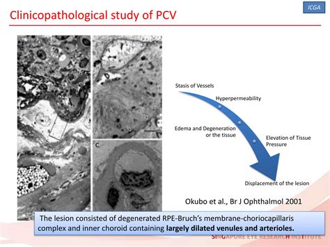 Pachychoroid Spectrum Diseases Pptx