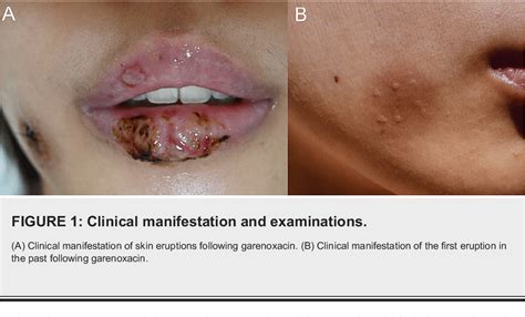 Figure 1 From Fixed Drug Eruption Caused By Garenoxacin A Case Report And Literature Review