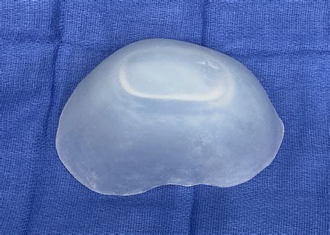 Custom Back Of Head Skull Implant Intraop Dr Barry Eppley Explore