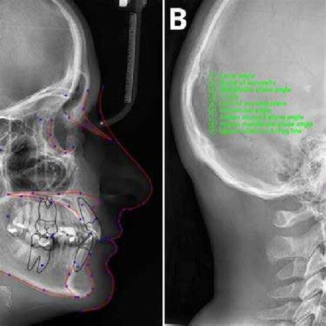sample of automatic cephalometric landmarks tracings performed by cephx