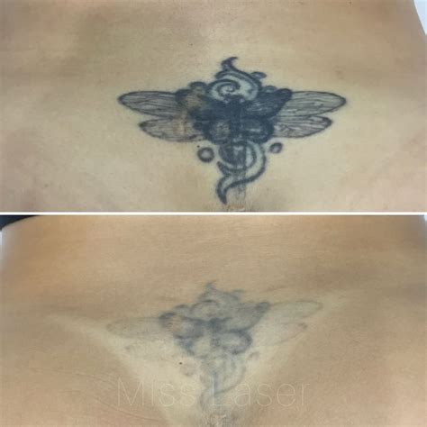 Tattoos Usually Fade More And More After Every Session It Will Take