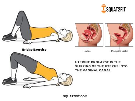 Pelvic Floor Exercises For Uterine Prolapse