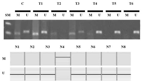 Loss Of RUNX3 Is Significantly Associated With Advanced Tumor Grade And