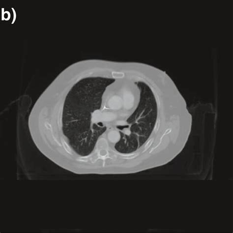 Simulated Planning Images With Geometric Distortion A Original Ct