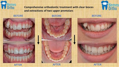 Tooth Extraction For Braces Before And After At Vaughn Gurule Blog