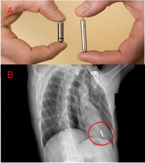 Second In A Series On Leadless Pacing Leadless Cardiac Pacemakers What Is To B
