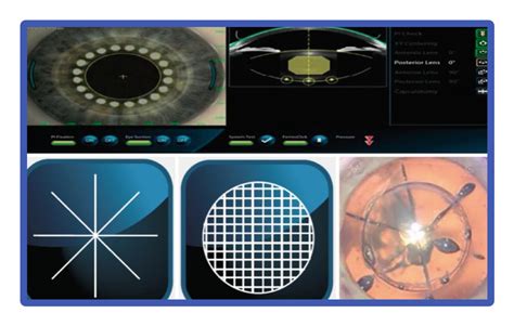 Flacs 飛秒激光輔助性白內障手術 香港建視眼科中心 Hong Kong Bright Eye Vision Centre 眼科醫生 湯文傑
