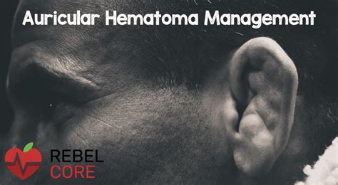 Auricular Hematoma Management Rebel Em Emergency Medicine Blog