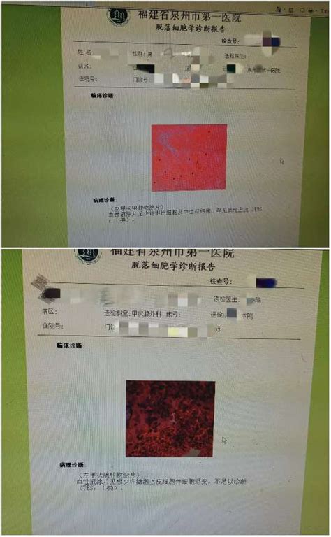 甲状腺细针穿刺与甲状腺细胞病理学Bethesda 报告系统
