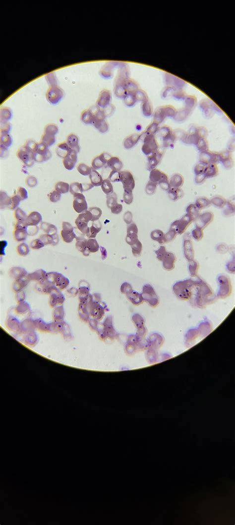 Preeti Rajput On Linkedin Malaria P Falciparum Banana Shape Ring Form