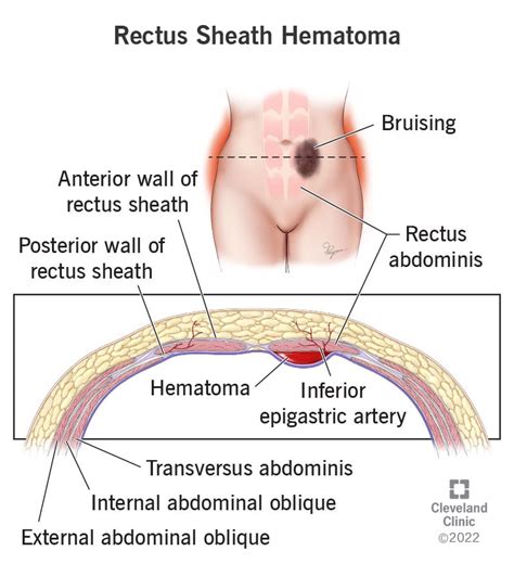 Rektusümbrise Anatoomia Ja Pärasoole ümbrise Hematoom Ravi Sfomc