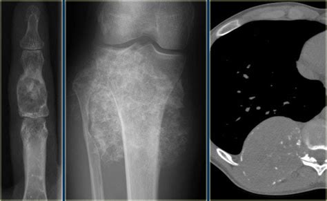 Radiologyspirit Chondroid Matrix