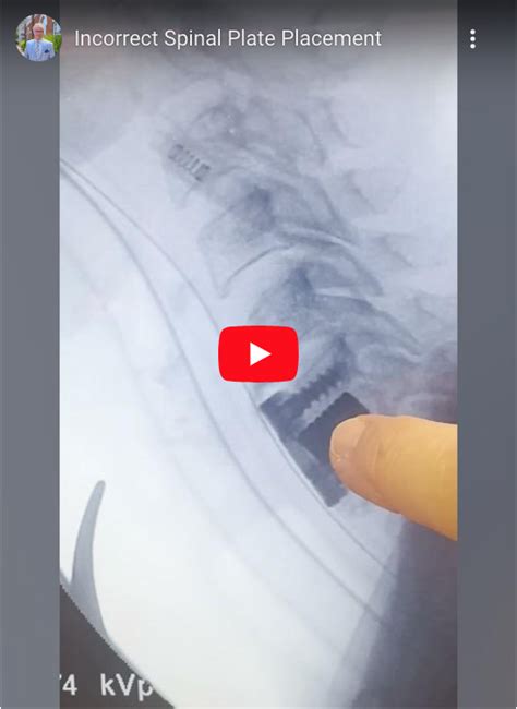 Incorrect Spinal Plate Placement William Capicotto M D Pc Buffalo Ny