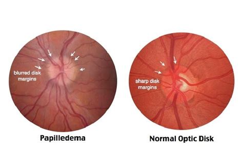 Papilledema Vs Glaucoma Papilledema Disc Swelling Co0032 Stock
