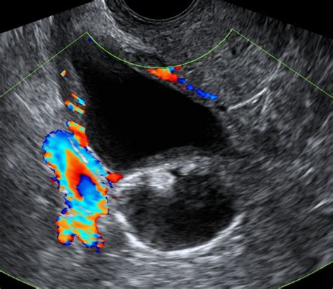 Ovarian Dermoid Medical Ultrasound Educational Websites Gynecology
