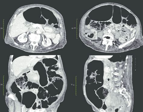 Ct Scan Sigmoid Volvulus Download Scientific Diagram