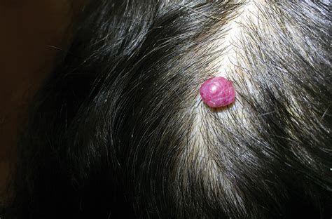 Growing Scalp Nodule Mdedge Growing Scalp Nodule Mdedge