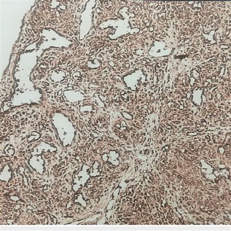 Vegf Immunohistochemistry 3 Intensity Staining Pattern In