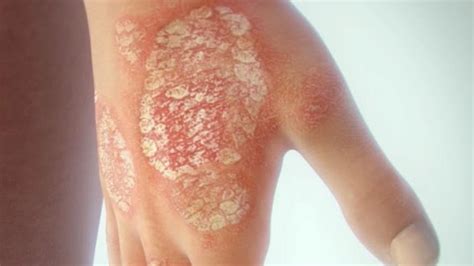 Qué es la psoriasis y cuáles son los tratamientos que existen