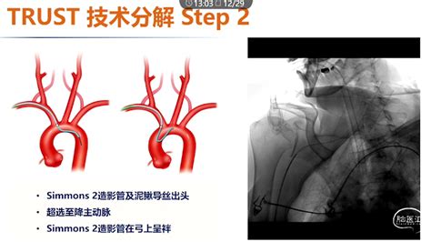 吴一娜教授：trust经桡中间导管同轴技术解析与应用 脑医汇