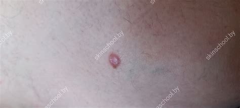 Дерматофибромы Советы дерматолога Sovetydermatologa Дзен