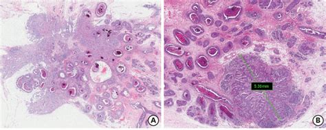 Extensive Intraductal Component Positive Invasive Carcinoma A Dcis Download Scientific