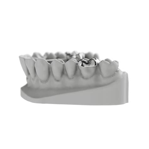 Compact Rpe Rapid Palatal Expander Odl Orthodontic Labs