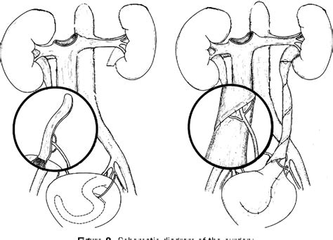 Figure 1 From Reconstructing Full Length Ureteral Defects Using A