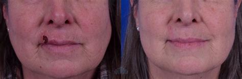 Mohs And Skin Cancer Surgery Before And After Photo Gallery Charlotte