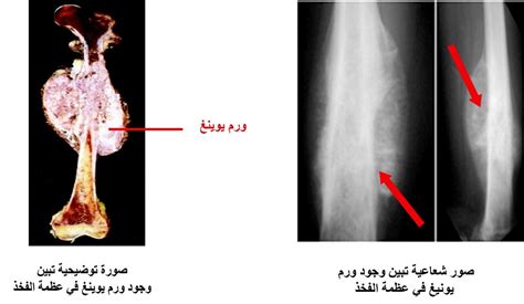 سرطان العظام Profabu Hassan