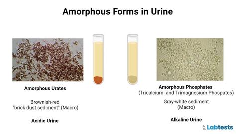 Amorphous Phosphate Crystals In Urine