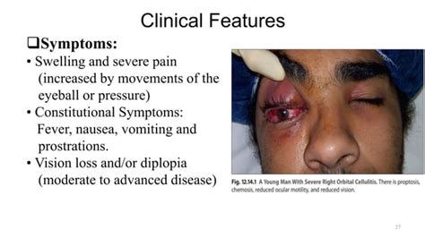 Preseptal Cellulitis And Orbital Cellulitis Dr Prabhat Devkotapptx