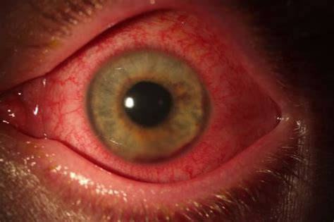 Iritis And Anterior Uveitis Innovative Eye Care