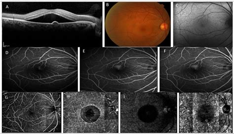 Central Serous Retinopathy Retina Image Bank