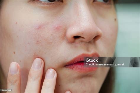 여드름과 피부 얼굴에 흉터 피지선의 장애 십대 소녀 스킨 케어 미용 문제 여드름에 대한 스톡 사진 및 기타 이미지 여드름