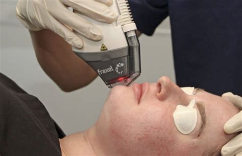 Fractional Resurfacing For Hyperpigmentation A Solution For Uneven