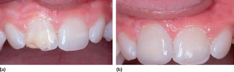 20 Developmental Defects Of The Dental Hard Tissues And Their