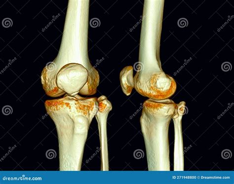 Ct Scan Of Knee Joint 3d Rendering Stock Illustration Illustration Of