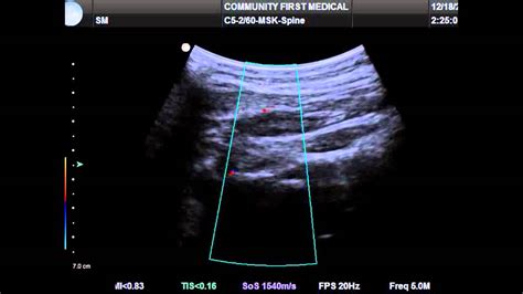 Ultrasound Guided Occipital Nerve Block Youtube